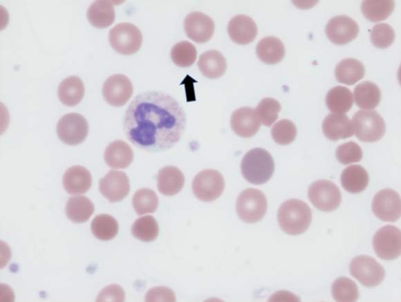 Poikilocytes • The Blood Project