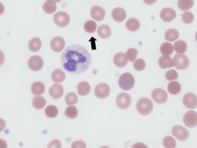 Poikilocytes • The Blood Project