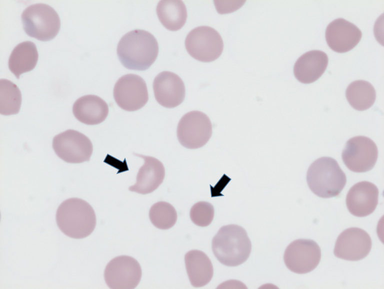 Poikilocytes • The Blood Project