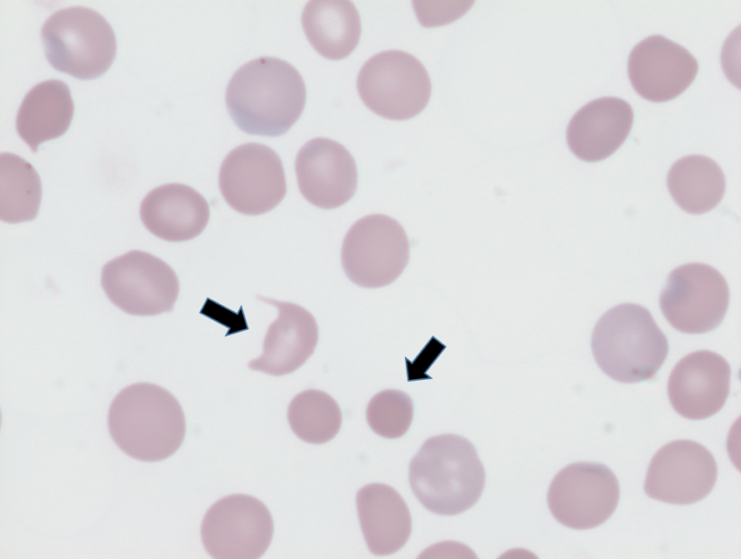 Poikilocytes • The Blood Project