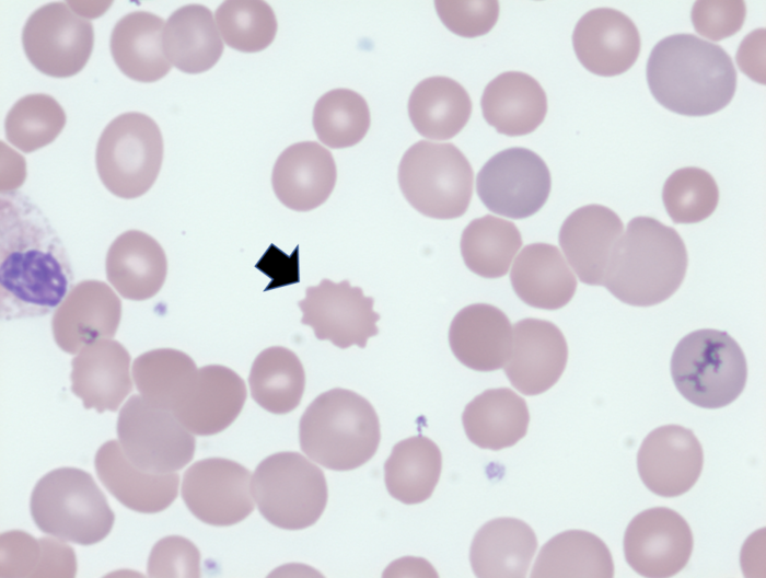 Poikilocytes • The Blood Project