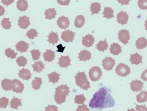 Poikilocytes • The Blood Project