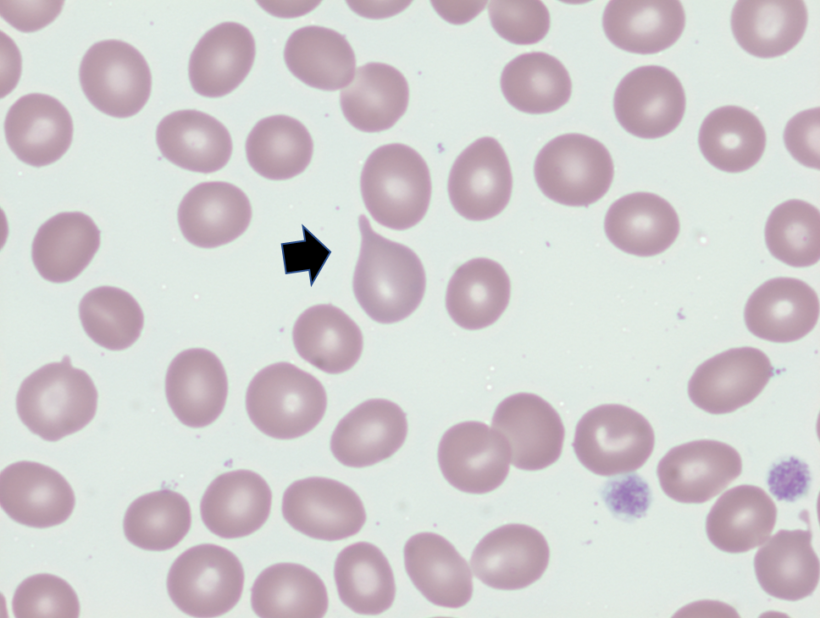 Poikilocytes • The Blood Project