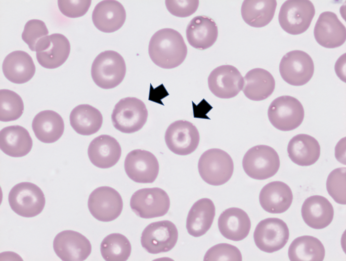 Poikilocytes • The Blood Project