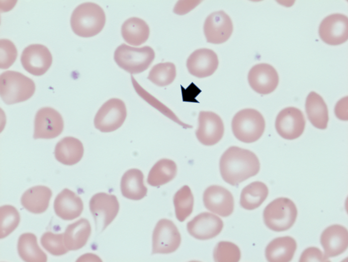 Poikilocytes • The Blood Project