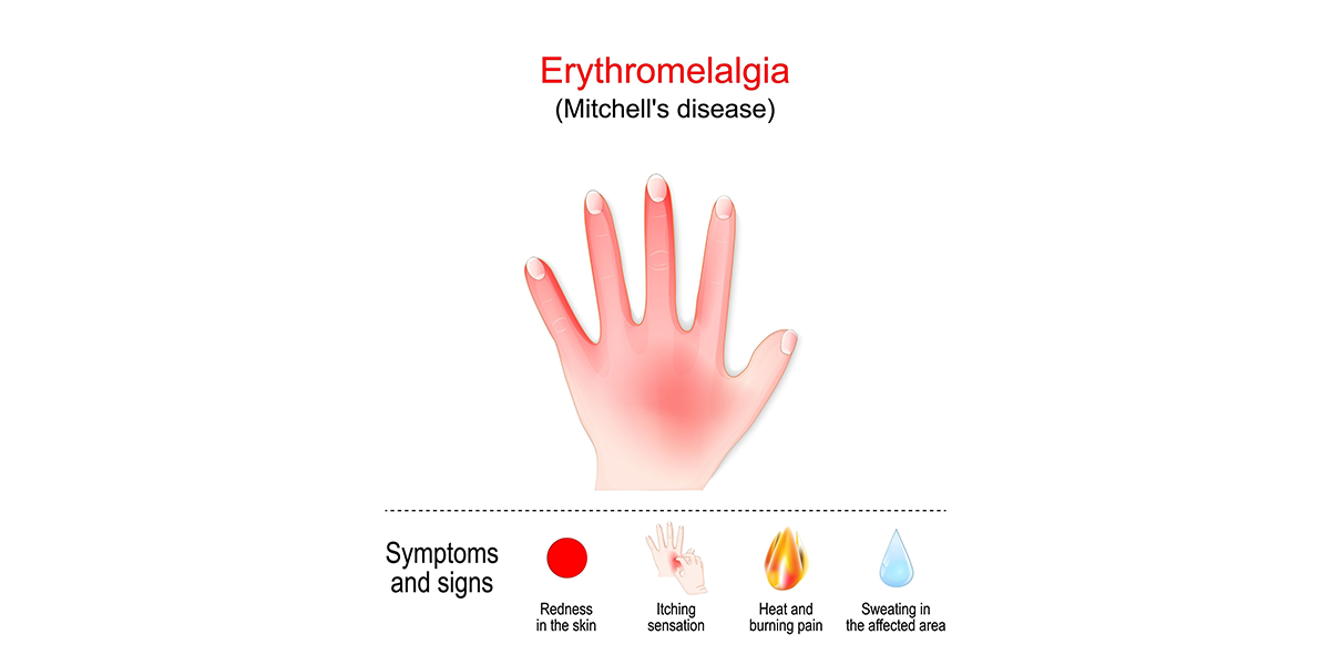 Erythromelalgia The Blood Project