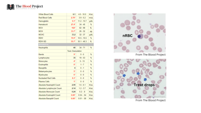 Leukoerythroblastic Picture vs. Myelophthisis • The Blood Project