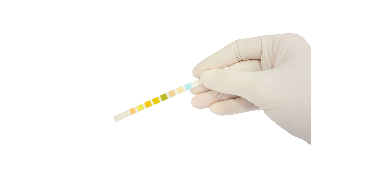 Urobilinogen in Hemolytic Anemia • The Blood Project