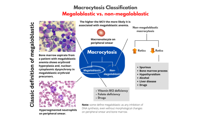 Classification of Macrocytosis • The Blood Project