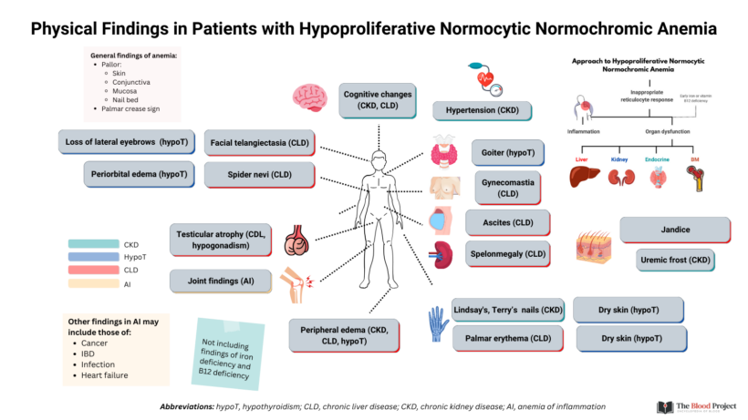 Physical Findings in Patients with Normocytic Anemia • The Blood Project