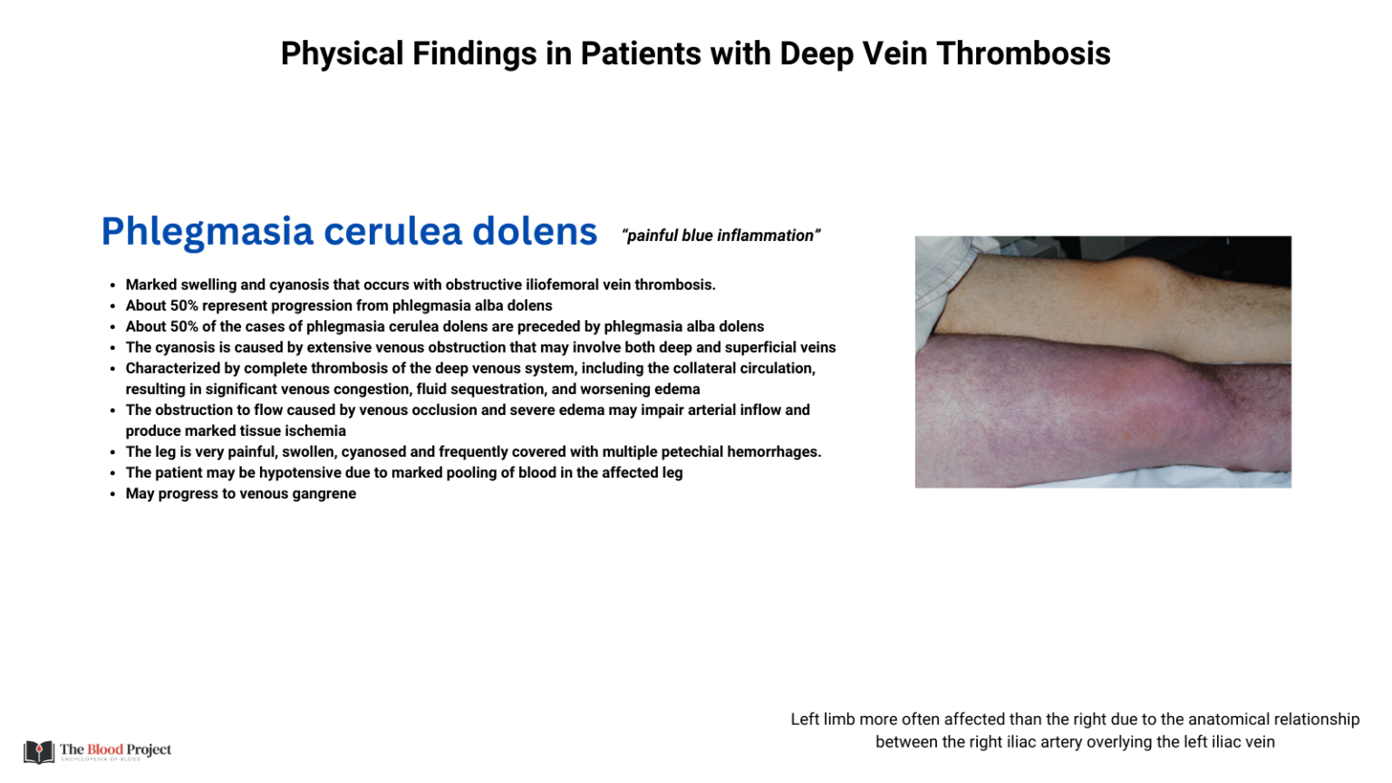 Physical Findings in Patients with DVT • The Blood Project