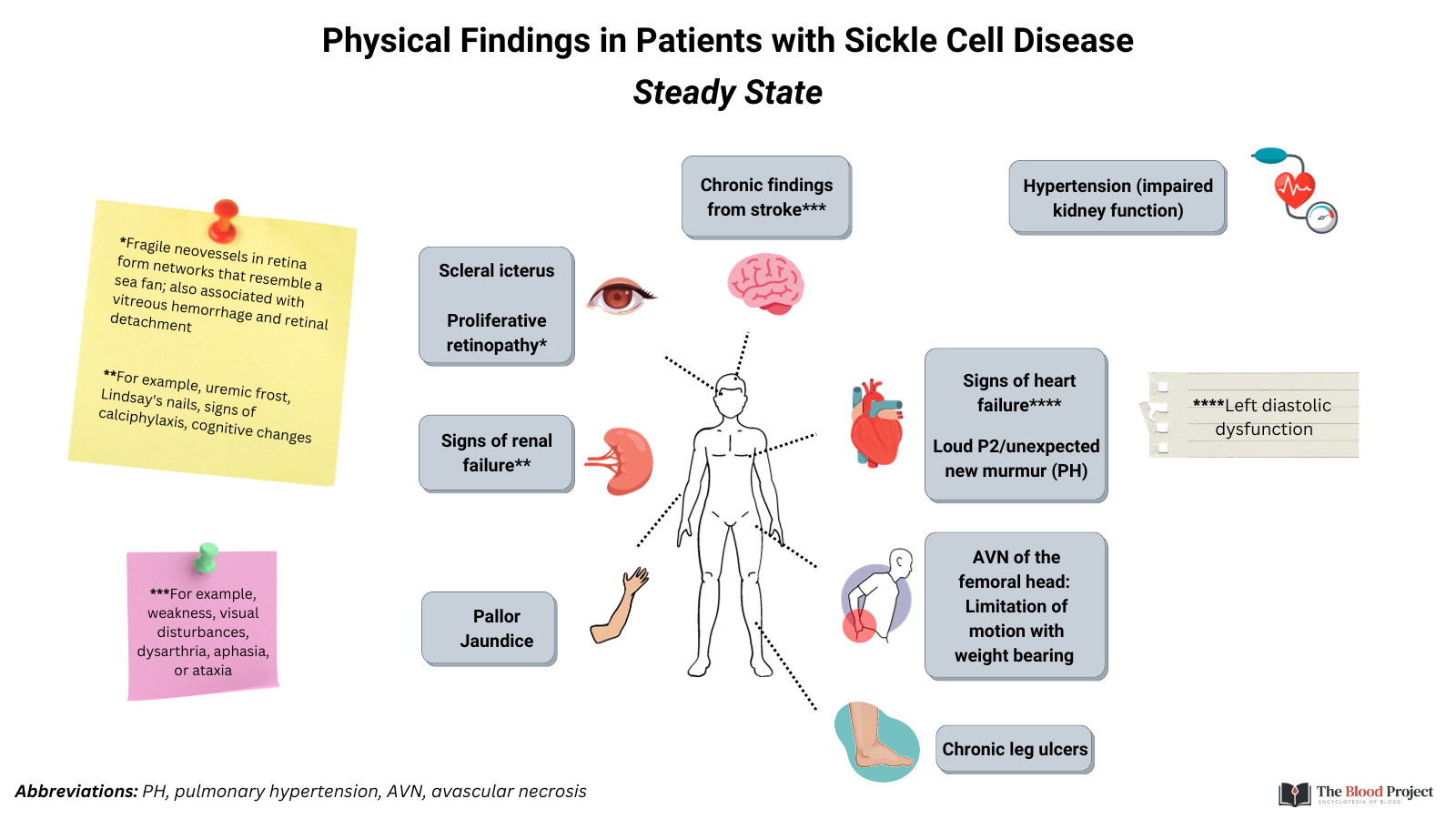 Physical Findings in Patients with Sickle Cell Disease • The Blood Project