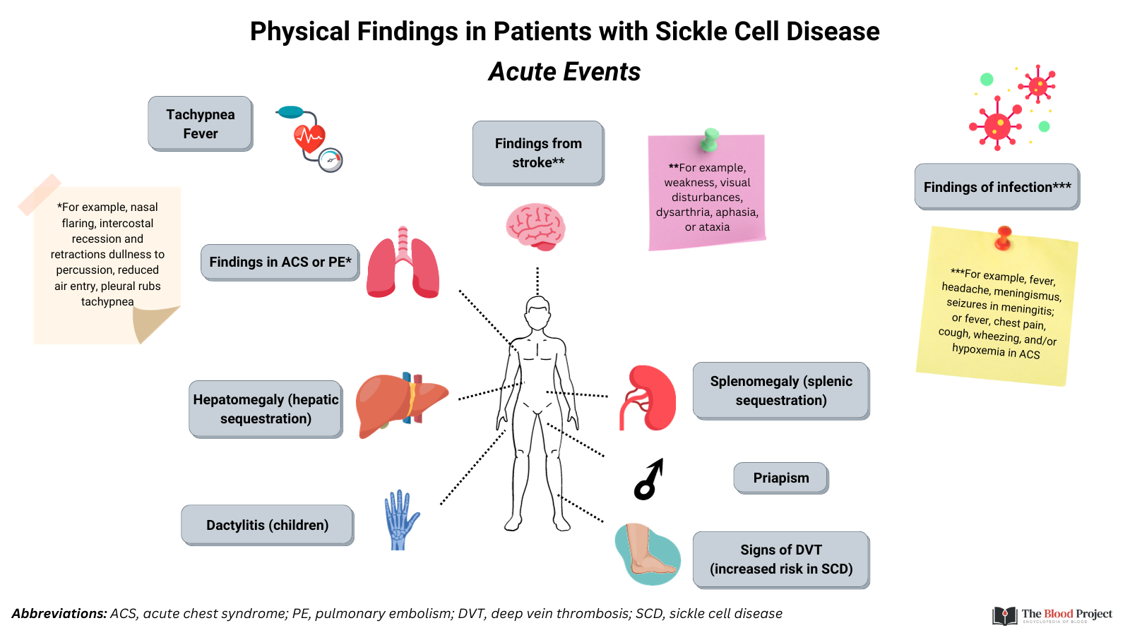 Physical Findings in Patients with Sickle Cell Disease • The Blood Project