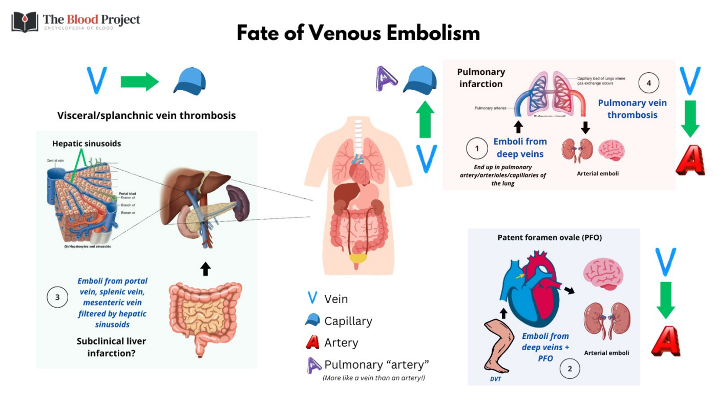 Fate of Venous Emboli • The Blood Project