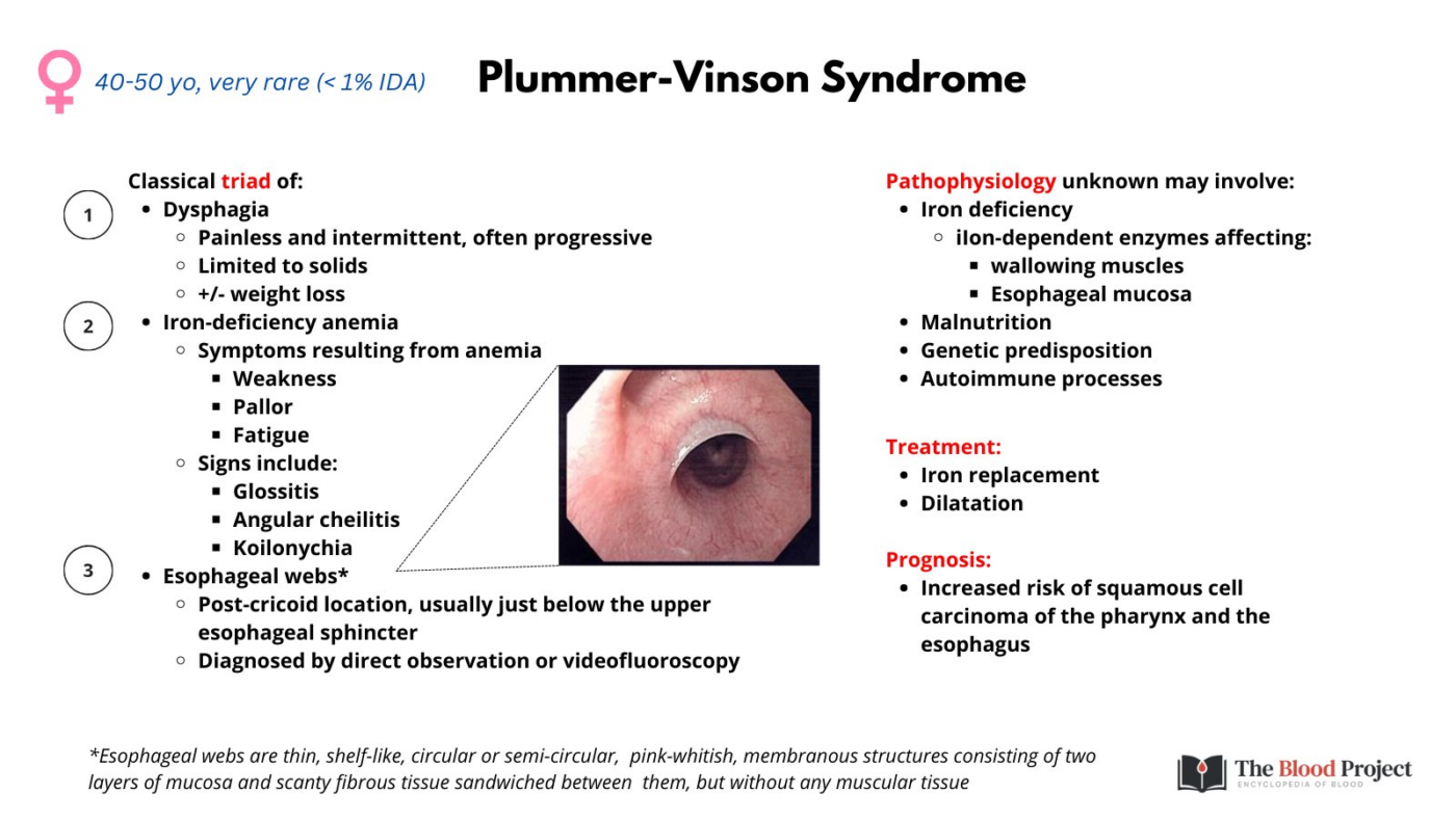 Plummer-Vinson Syndrome • The Blood Project