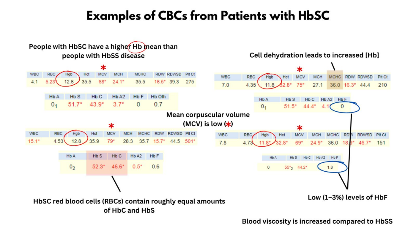 HbSC Disease • The Blood Project