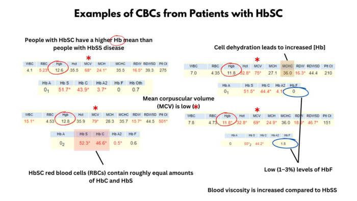 HbSC Disease • The Blood Project