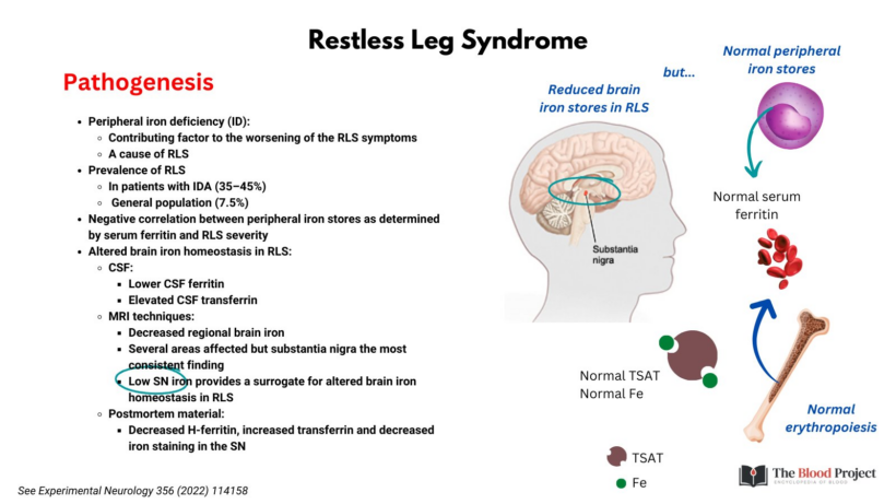Iron Therapy in Restless Leg Syndrome • The Blood Project