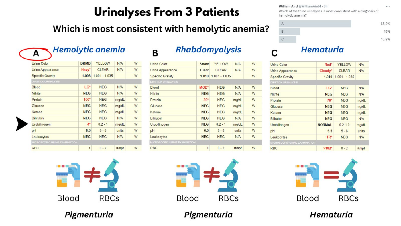 Urobilinogen in Hemolytic Anemia • The Blood Project