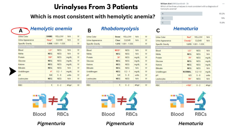 Urobilinogen in Hemolytic Anemia • The Blood Project
