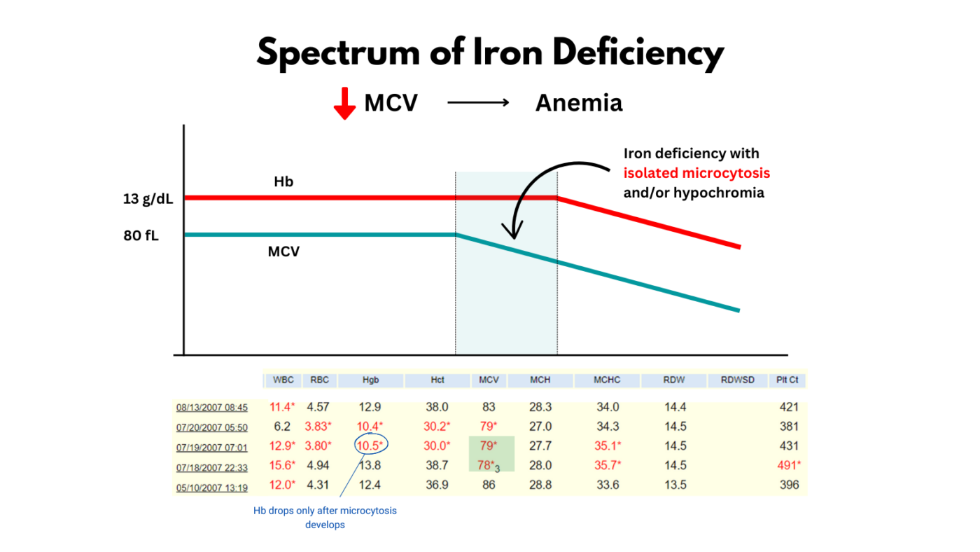 Temporal Pattern of MCV and Hb reduction in Iron Deficiency Anemia ...