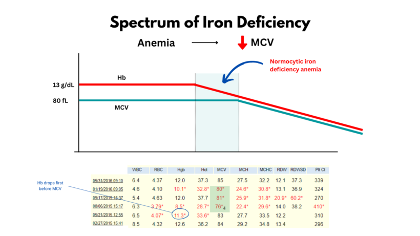 Temporal Pattern of MCV and Hb reduction in Iron Deficiency Anemia ...