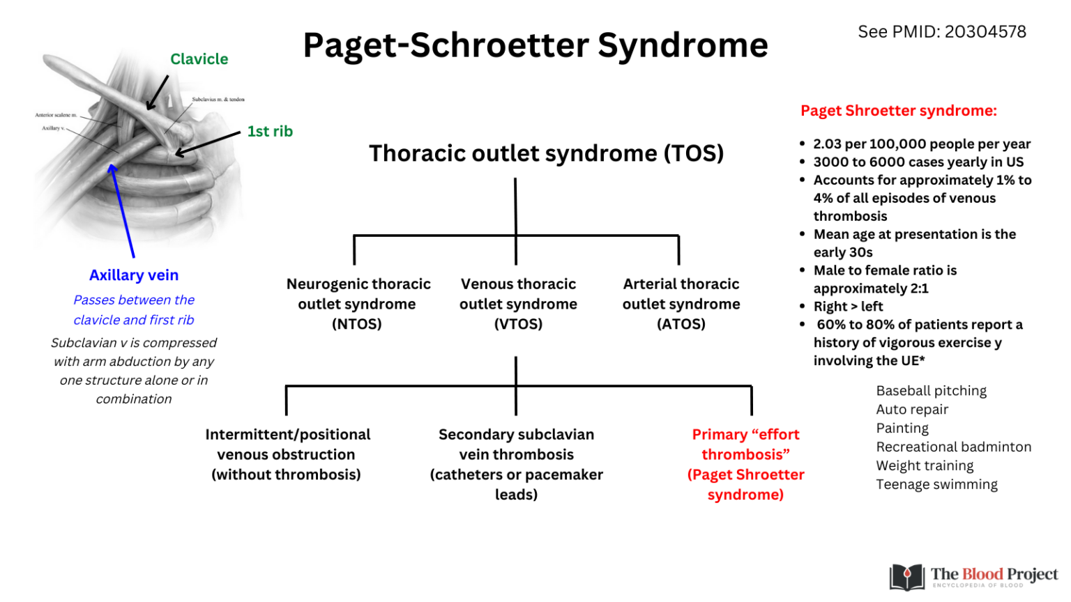 Eponyms in Hematology - Paget-Schroetter Syndrome • The Blood Project