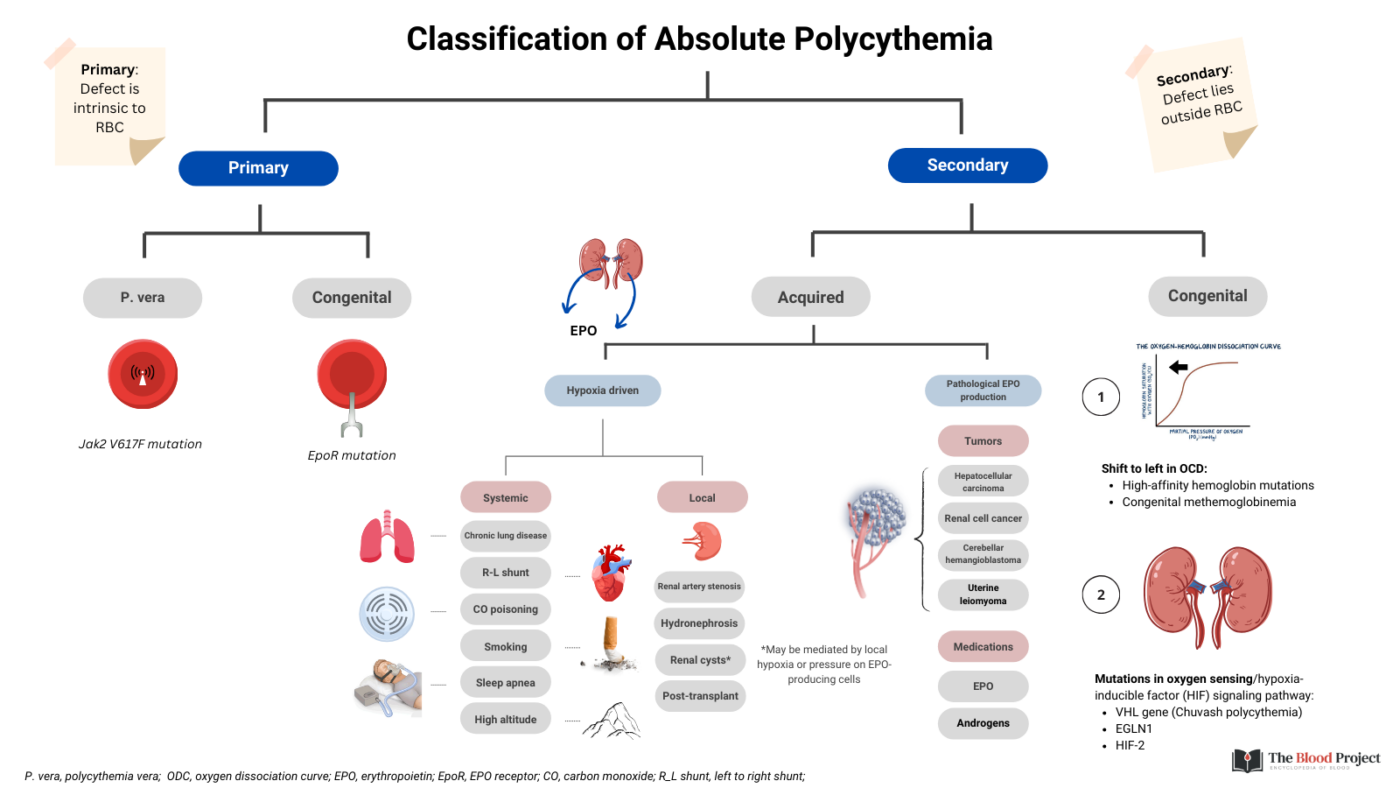 Classification of Absolute Polycythemia • The Blood Project