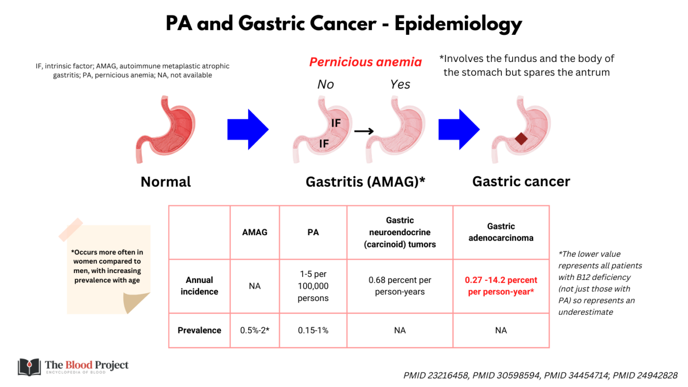 Should I Perform Endoscopy on my Patient with Pernicous Anemia? • The ...