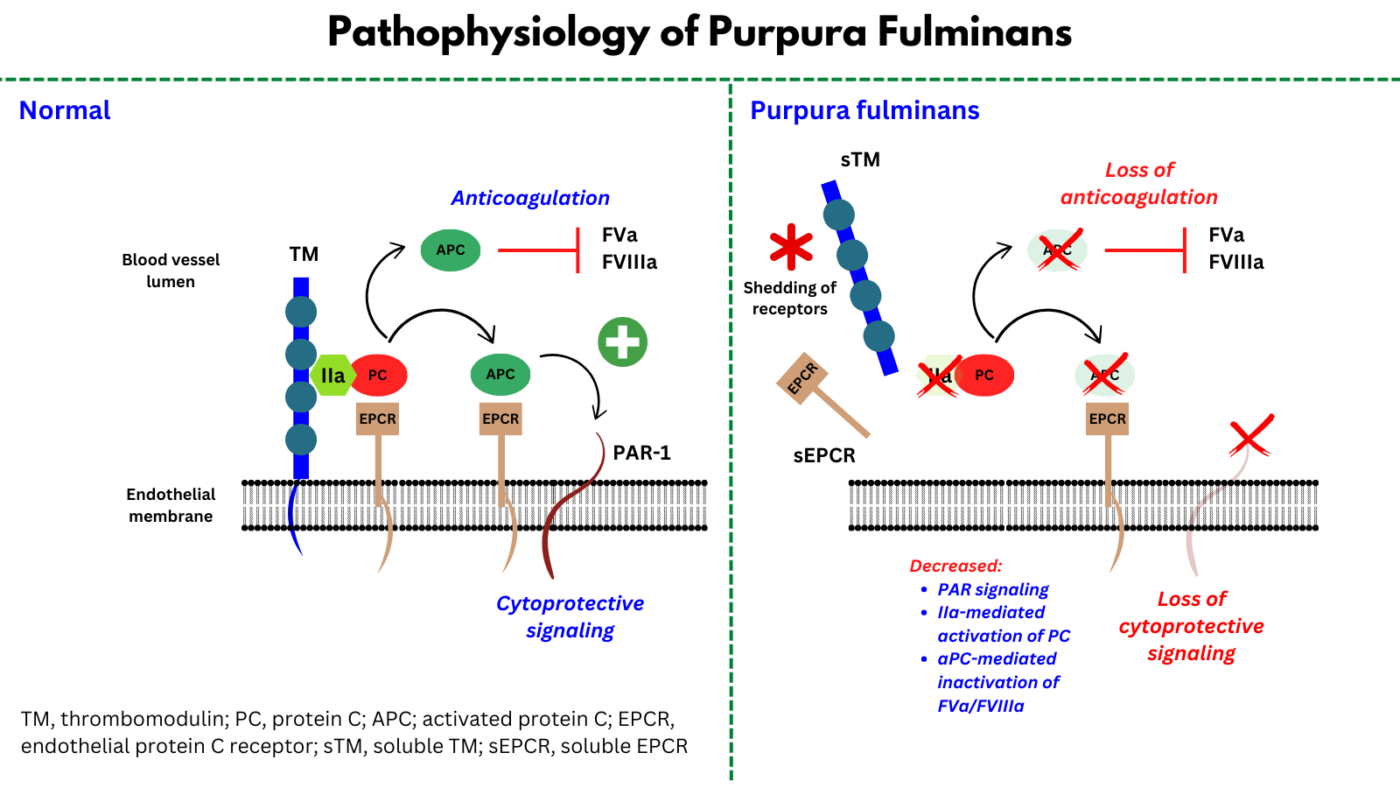 Purpura Fulminans • The Blood Project