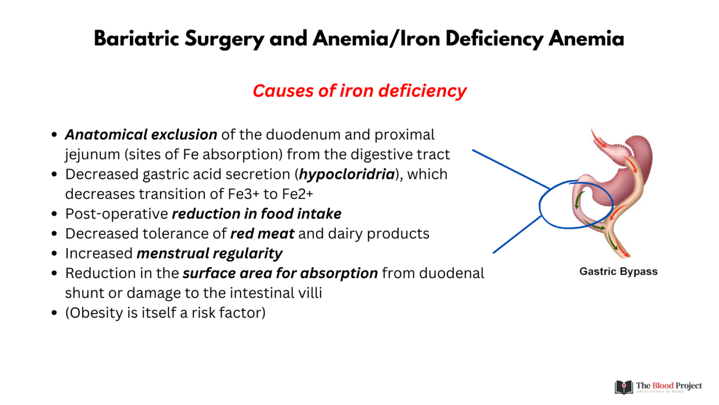 Iron Deficiency in Bariatric Surgery • The Blood Project