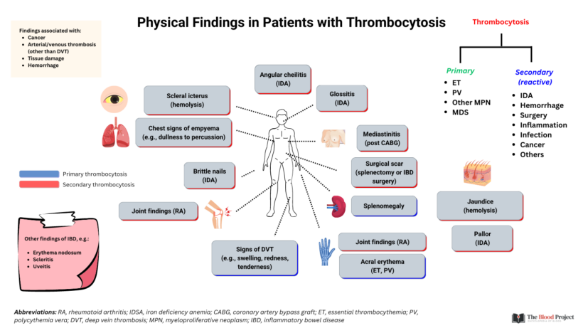 Physical Findings in Patient with Thrombocytosis • The Blood Project