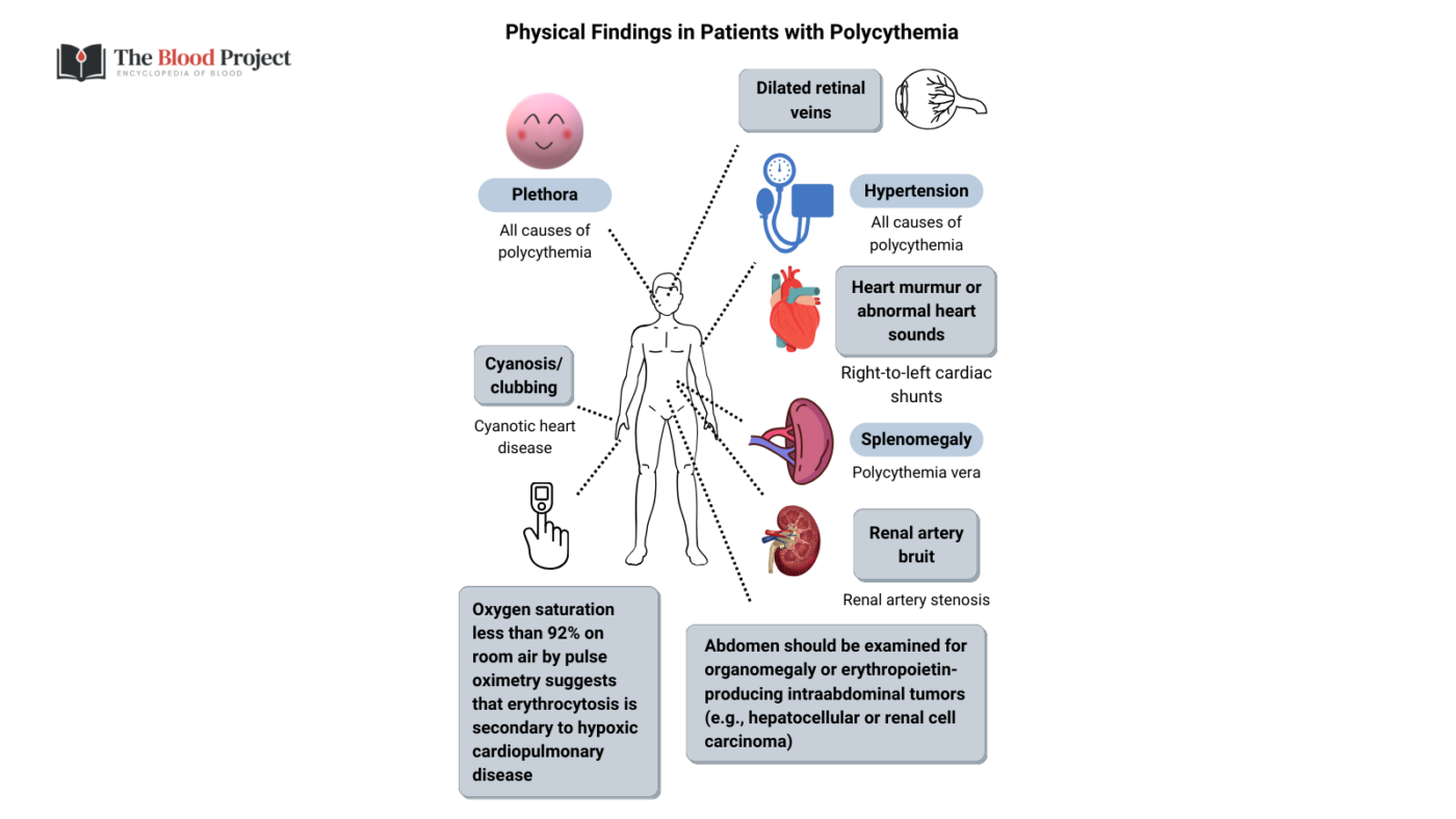 Physical Findings in Patient with Polycythemia • The Blood Project