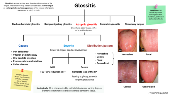 Atrophic Glossitis • The Blood Project