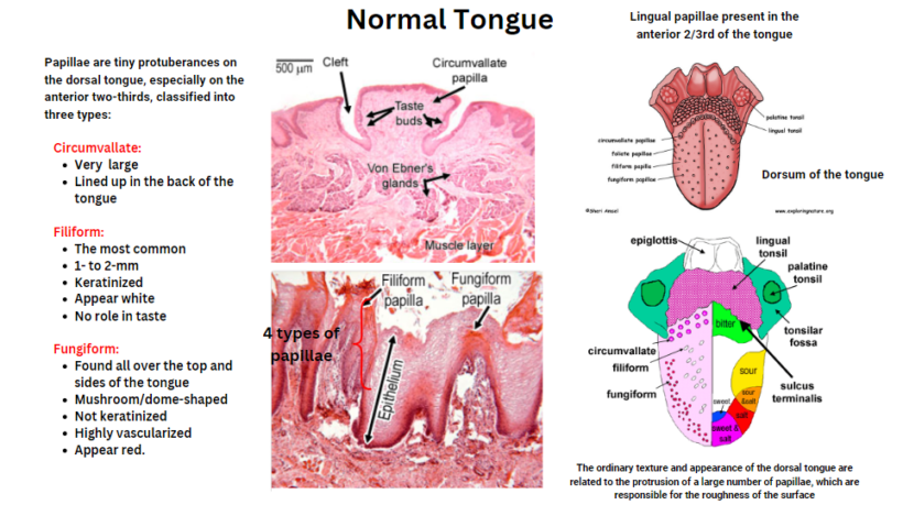 Atrophic Glossitis • The Blood Project