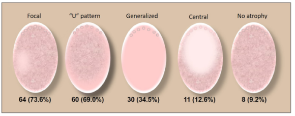 Atrophic Glossitis • The Blood Project