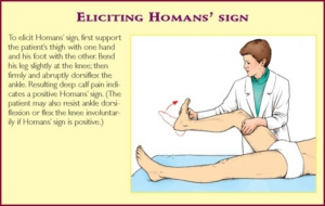 Eponymic Physical Signs in Deep Vein Thrombosis • The Blood Project