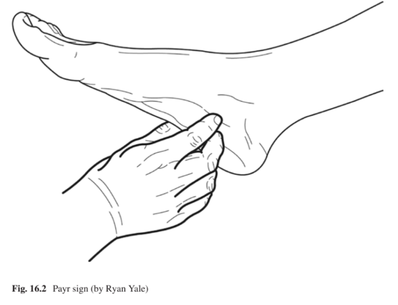 Eponymic Physical Signs in Deep Vein Thrombosis • The Blood Project