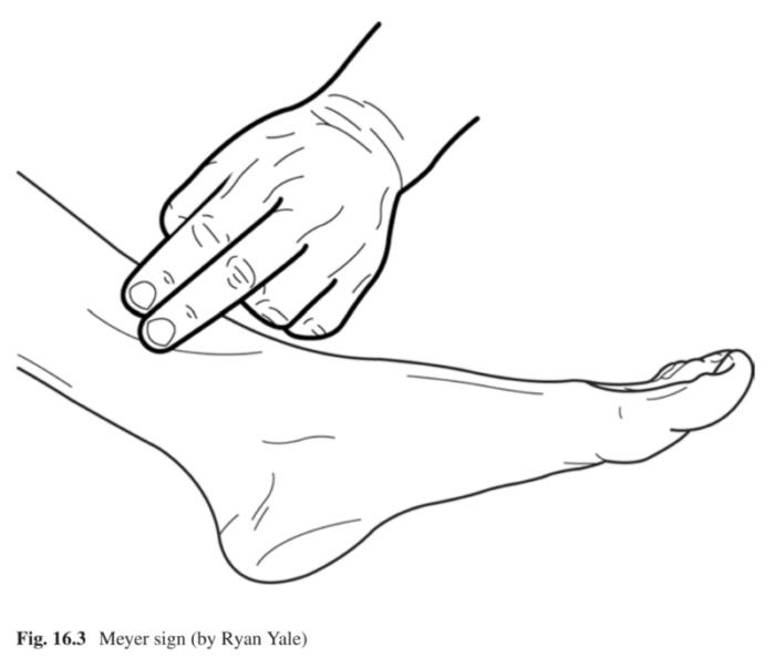 Eponymic Physical Signs in Deep Vein Thrombosis • The Blood Project