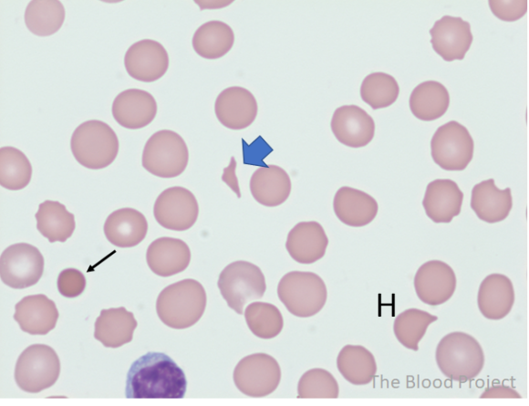 42 yo M with Hemolytic Anemia and Thrombocytopenia • The Blood Project