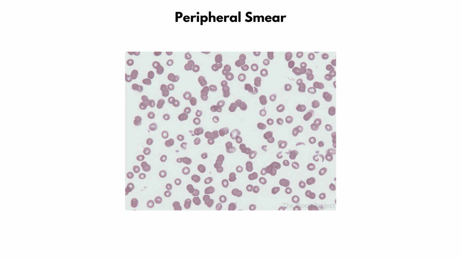 Erythrocyte Sedimentation Rate • The Blood Project
