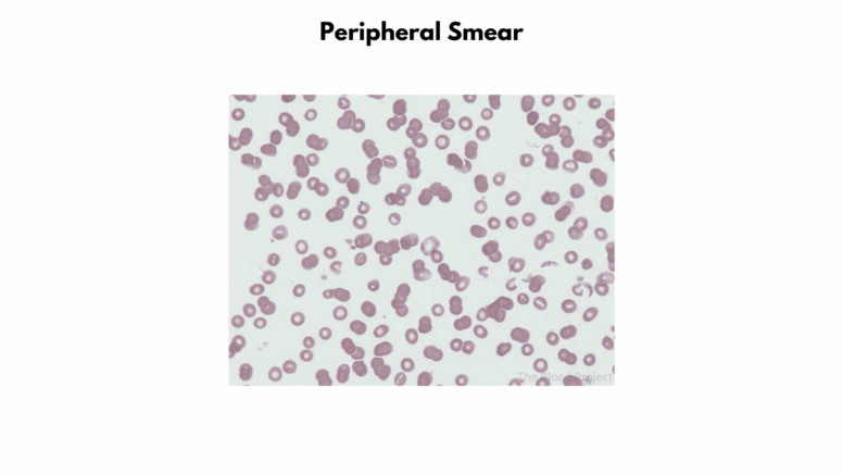 Erythrocyte Sedimentation Rate • The Blood Project