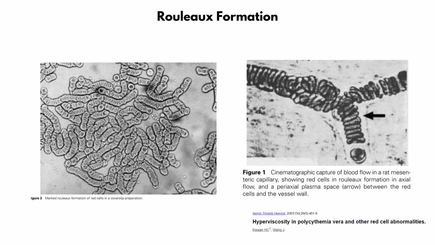 Erythrocyte Sedimentation Rate • The Blood Project