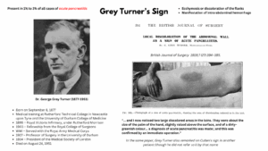 Eponyms in Hematology - Grey Turner’s Sign • The Blood Project