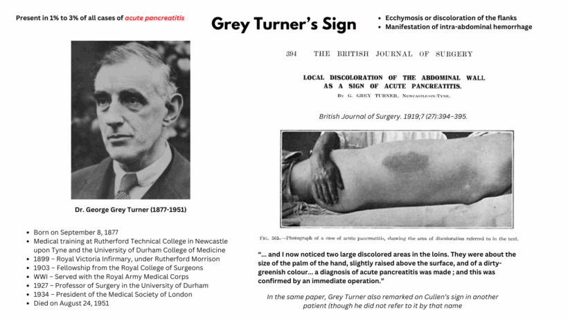 Eponyms in Hematology - Grey Turner’s Sign • The Blood Project