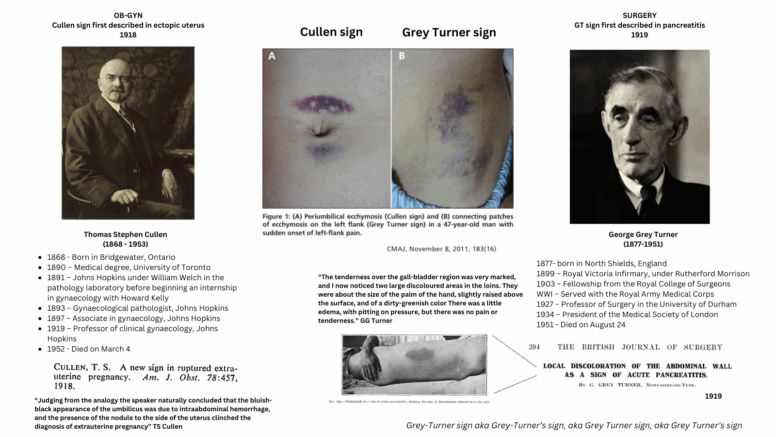 Eponyms in Hematology - Cullen's Sign • The Blood Project
