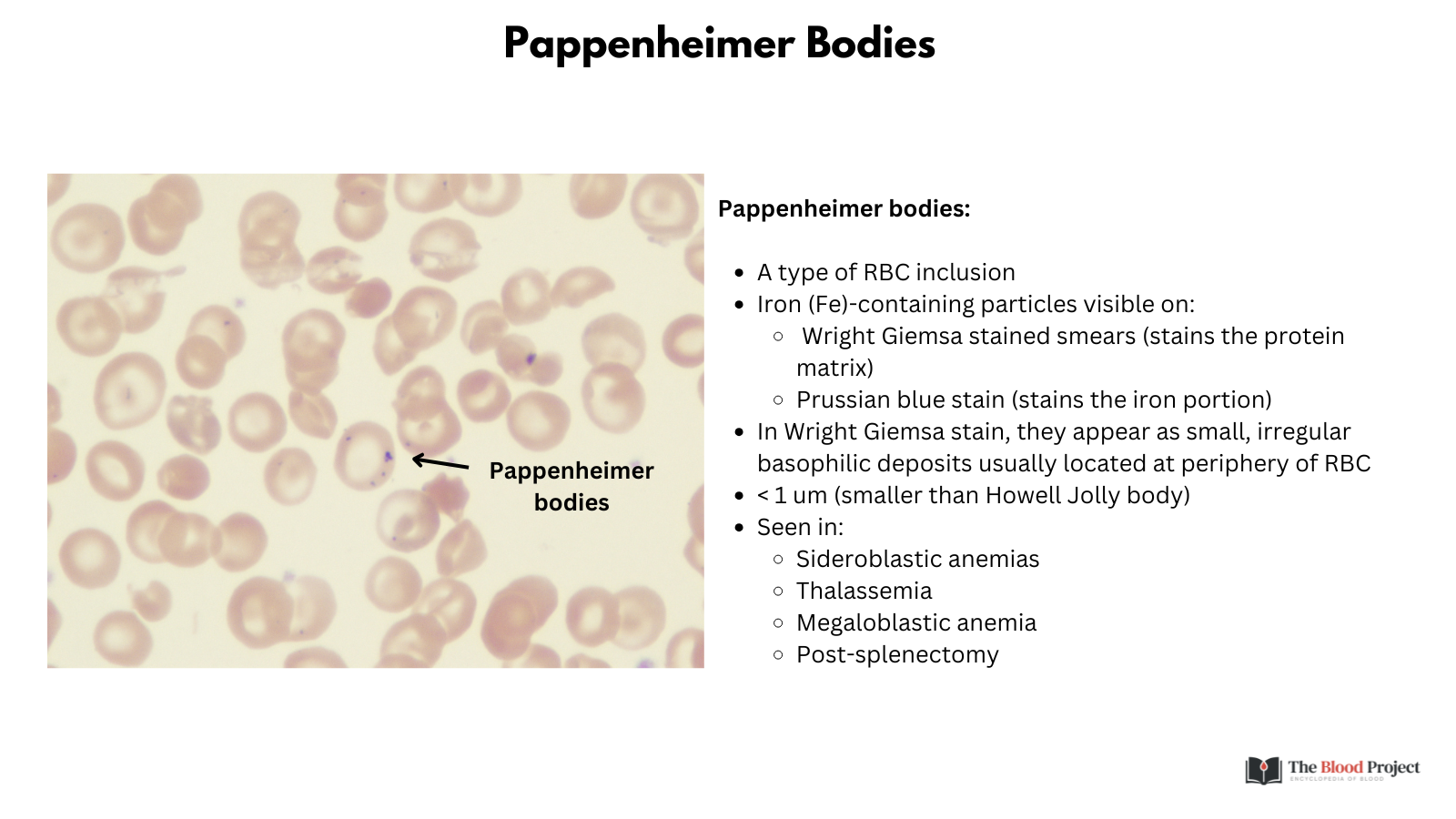 Eponyms in Hematology - Pappenheimer Body • The Blood Project