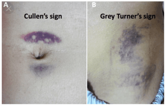 Eponyms in Hematology - Cullen's Sign • The Blood Project