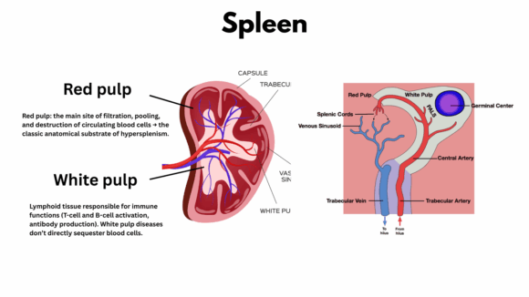 Hypersplenism • The Blood Project