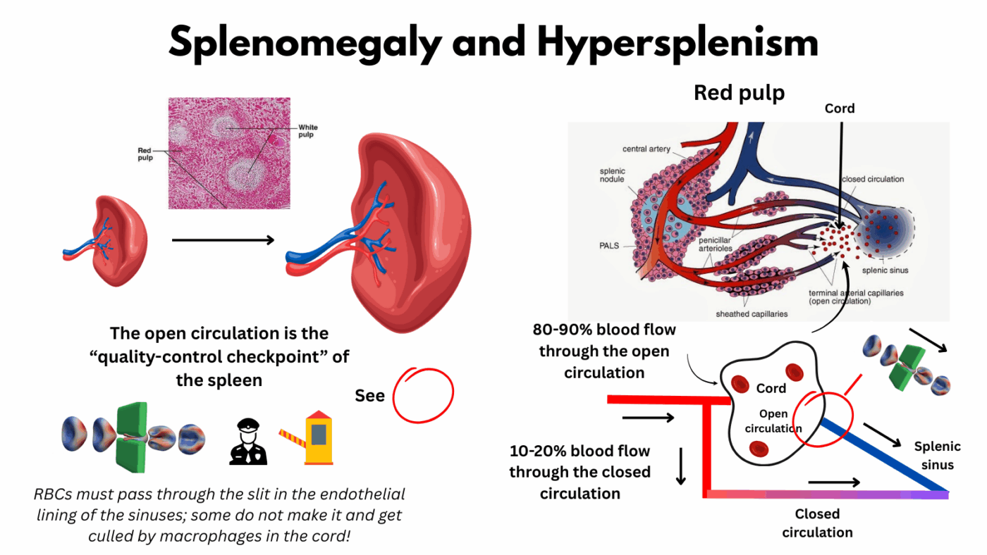Hypersplenism • The Blood Project